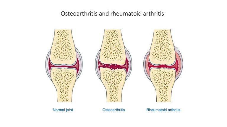 Arthritis Osteo vs Rheumatoid simplified